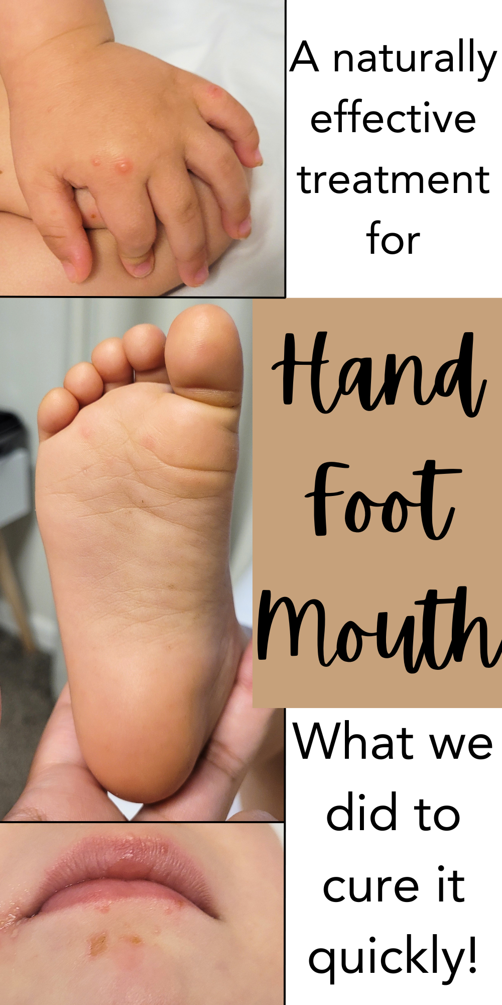 The Best Natural Treatment For Hand Foot Mouth Disease - Traditional ...